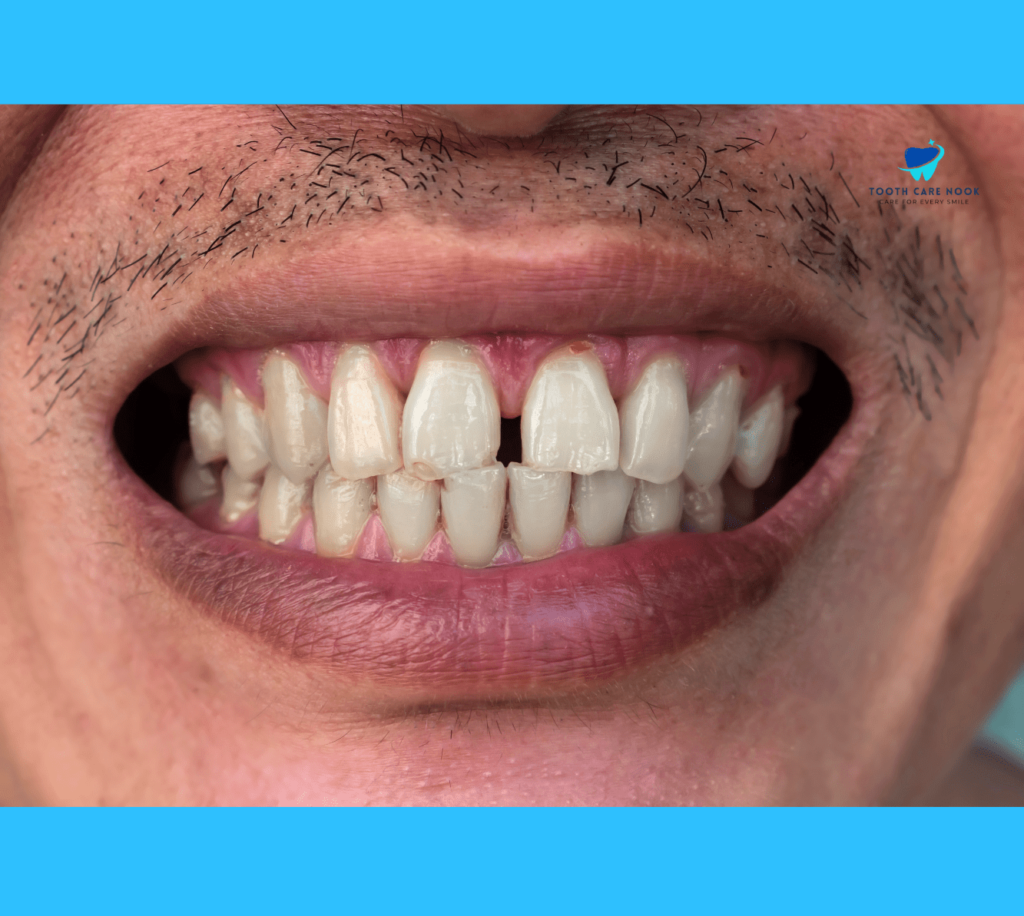 What is Lateral Incisor
