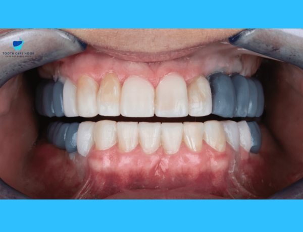 What is Posterior Teeth