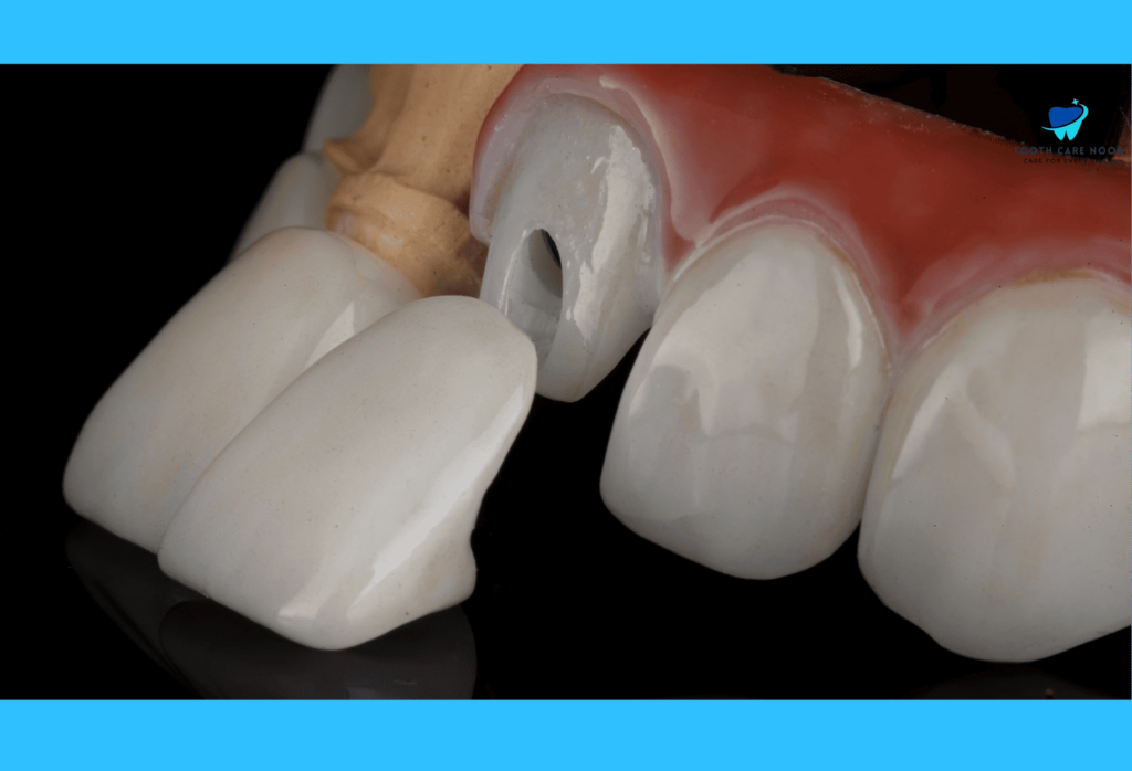 How is a Crown Attached to a Dental Implant | Know the Process