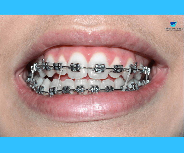 Triangle Rubber Bands For Braces | All You Need to Know