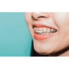 Why Bite Plate With Braces is Needed | A Comprehensive Guide