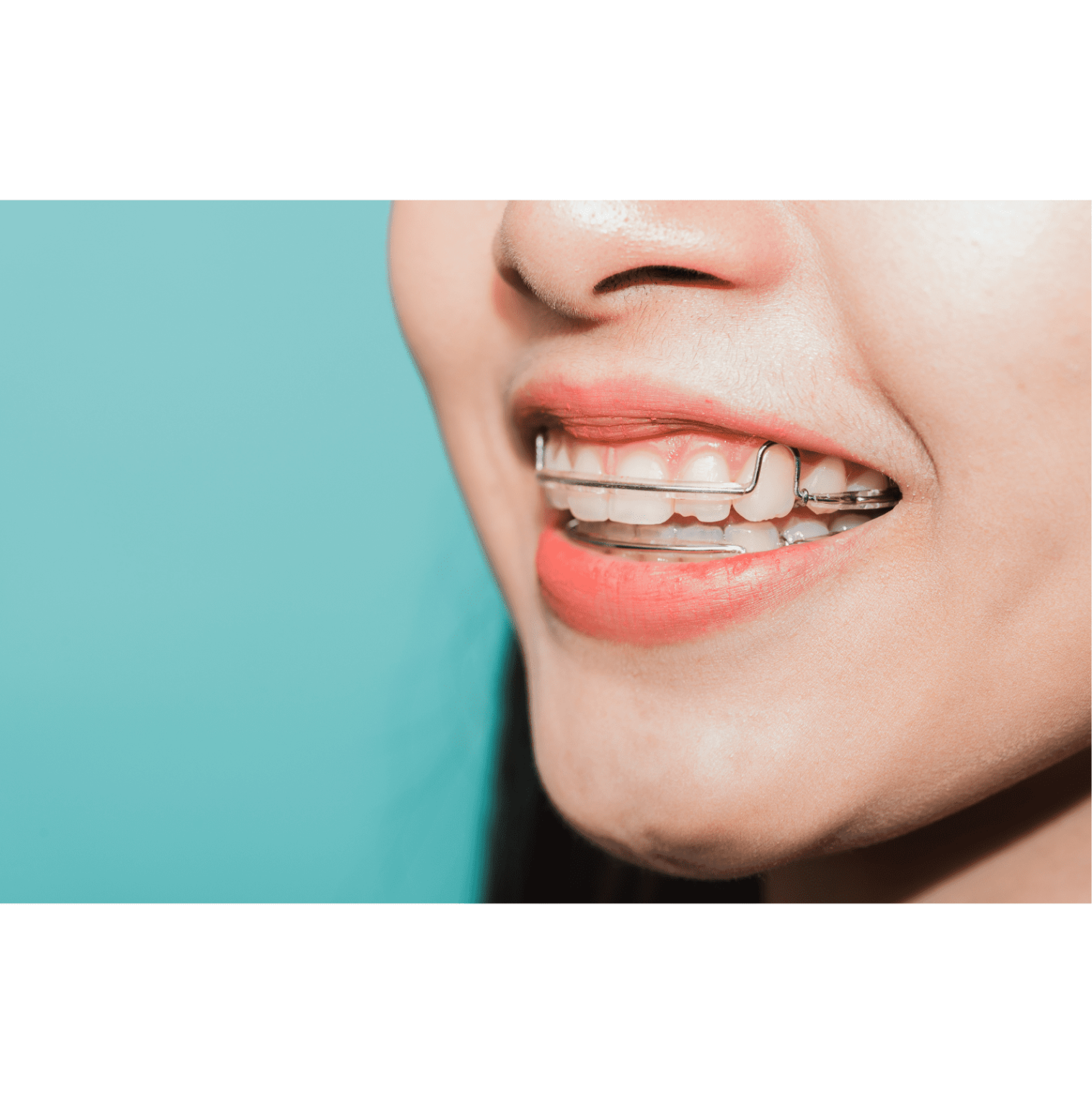 Why Bite Plate With Braces is Needed | A Comprehensive Guide