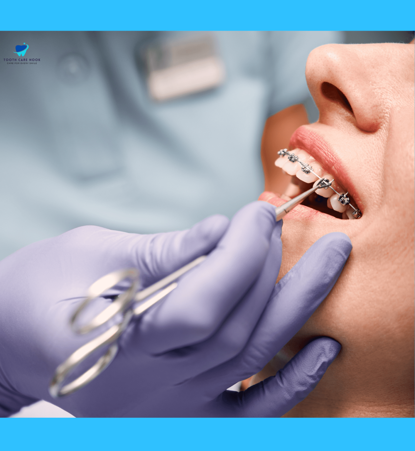 What is Braces Bonding? | A Comprehensive Guide