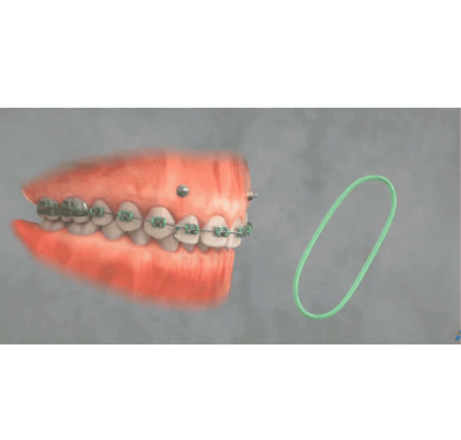 Temporary Anchorage Devices (TADs) For Braces | Know it All