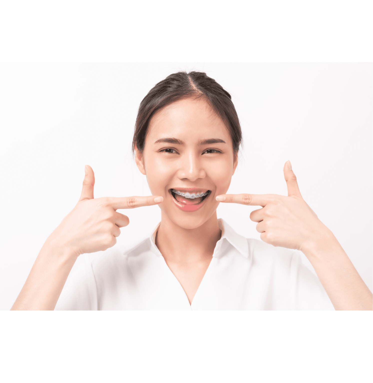 What Are Gold Braces For Teeth | A Complete Guide?