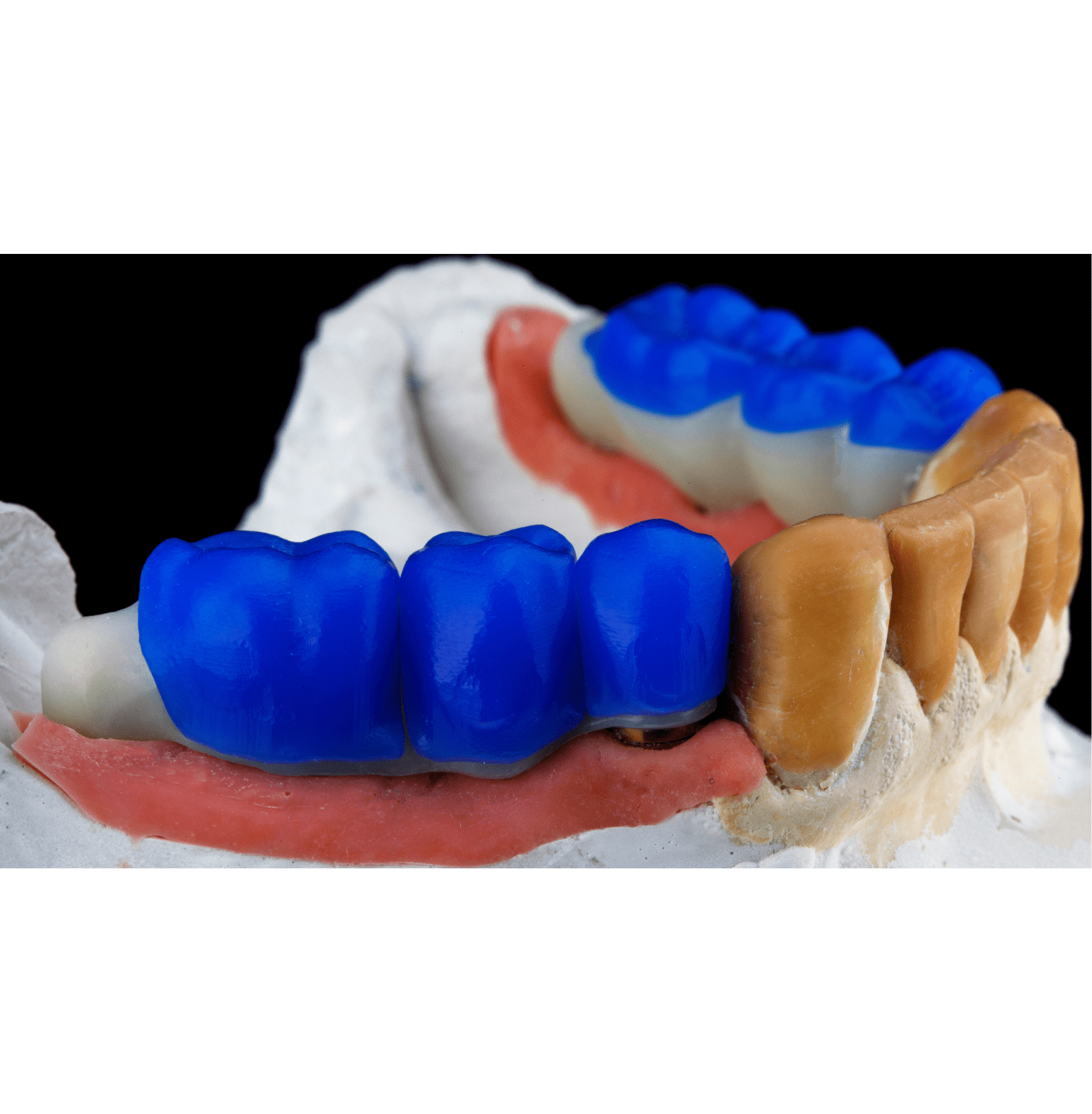 What Is a Wax-Up in Dental? | What Dentists Say