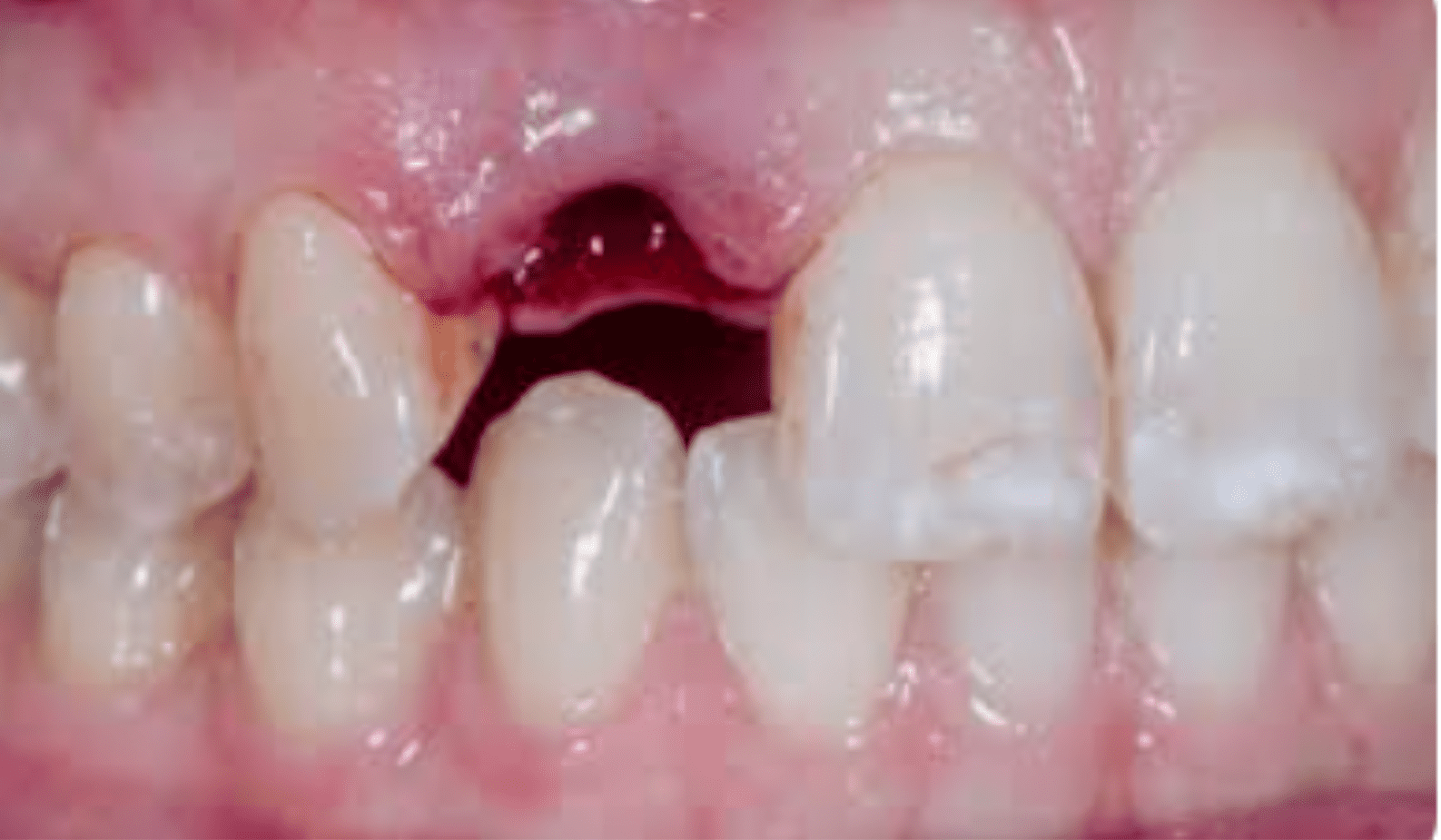 Can Loose Teeth Tighten Back Up? - A Quick Dental Guide