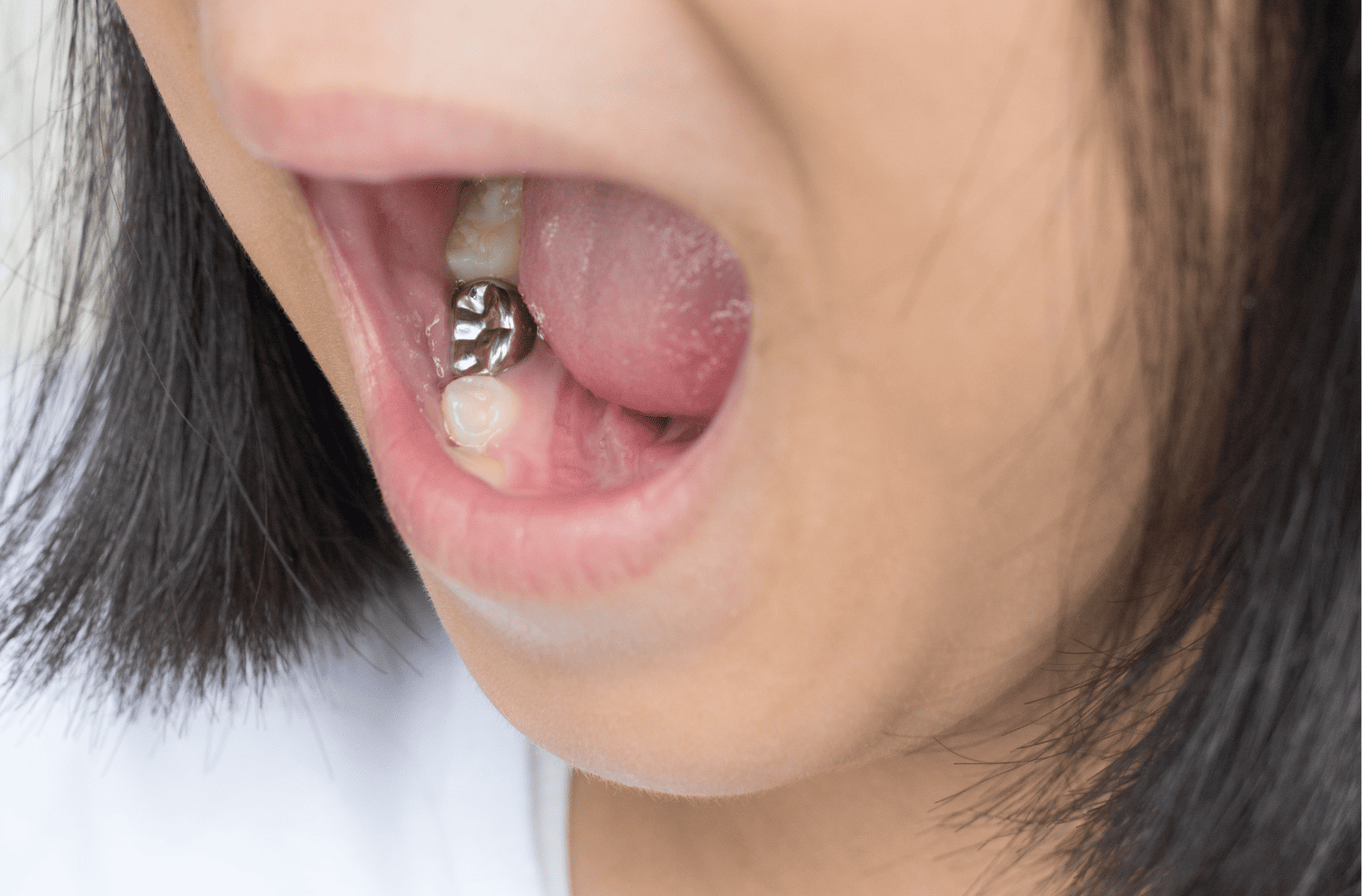 What Is Silver Cap Tooth? | Usage, Benefits, And All
