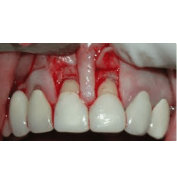 What is Flap Surgery in Dental? | Dental Surgeon's Take