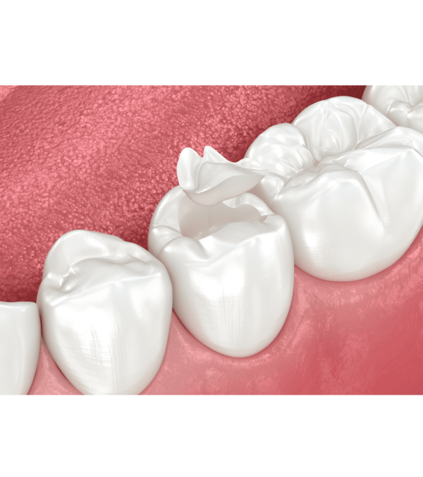 What is a Dental Overlay | Reasons You Need It