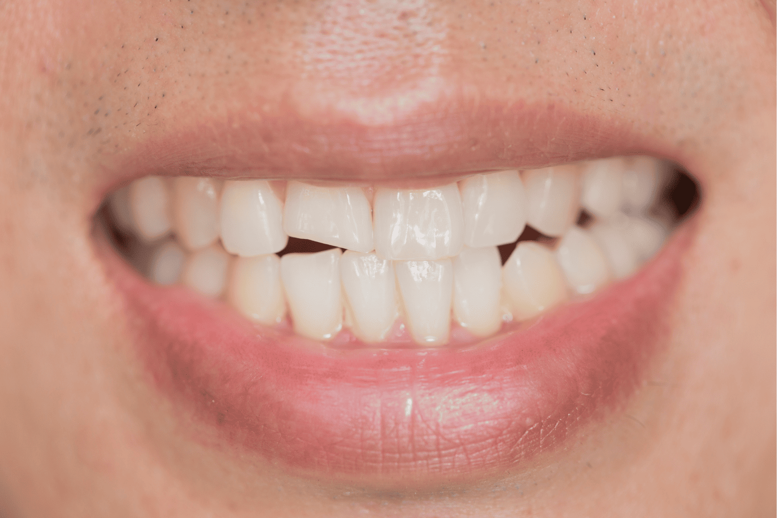 Why Do My Teeth Keep Chipping | Here's a Mystery Solved