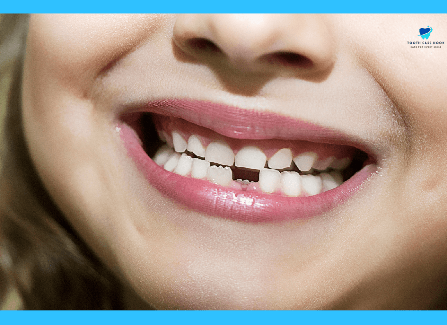 What Are Supraerupted Teeth | Causes, Treatment And All