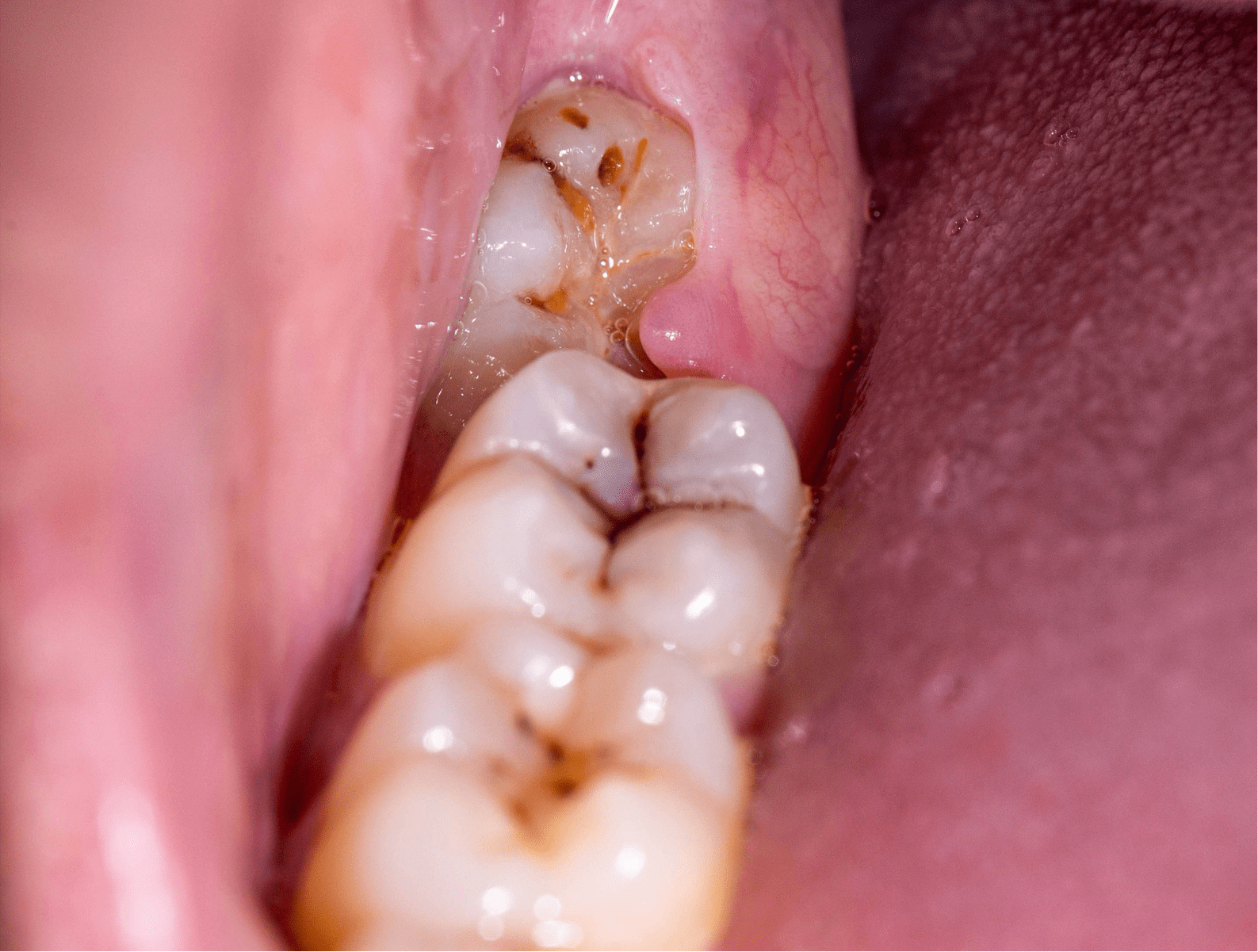 How To Get Food Out Of Wisdom Tooth Hole? | Here Are Tricks