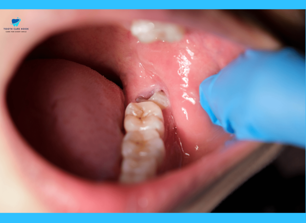 How To Get Food Out Of Wisdom Tooth Hole? | Here Are Tricks