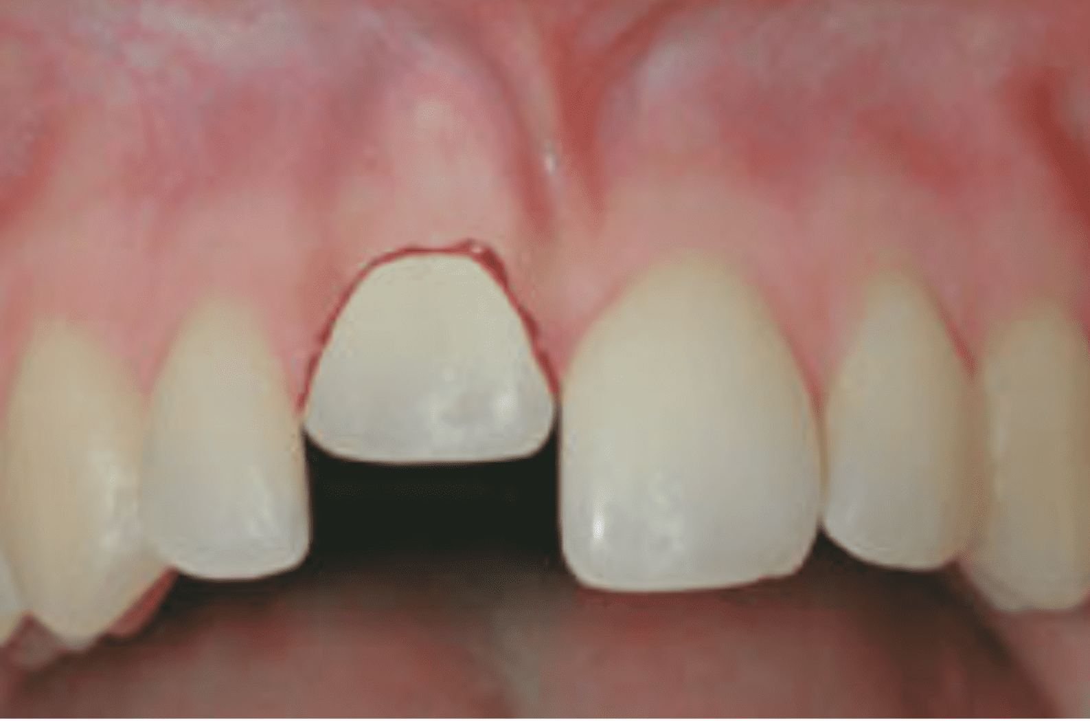 What Is Intrusion Of Teeth? | A Comprehensive Dental Guide